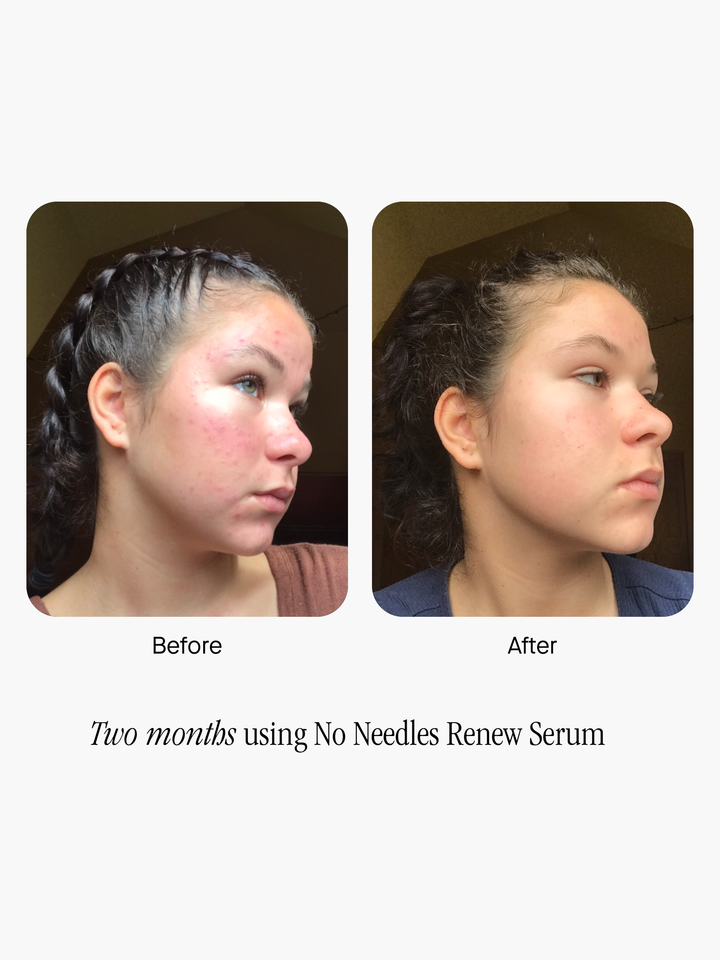 No Needles Renew Serum – Brandefy